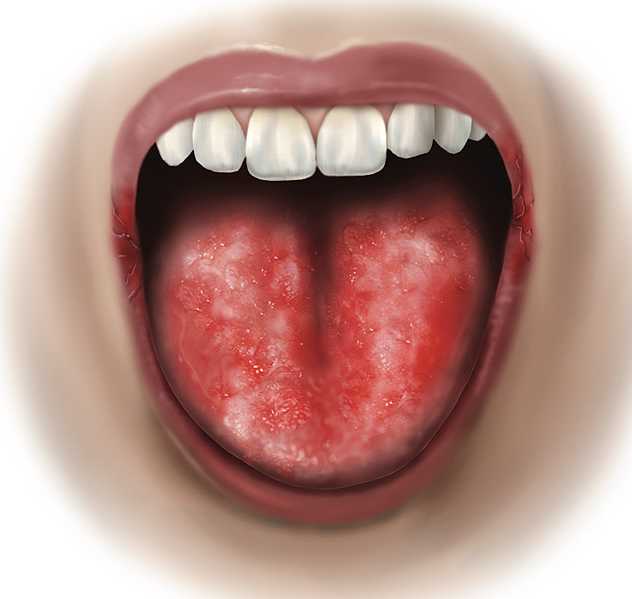 Burning Mouth Syndrome (BMS) | Anat Sapan MD